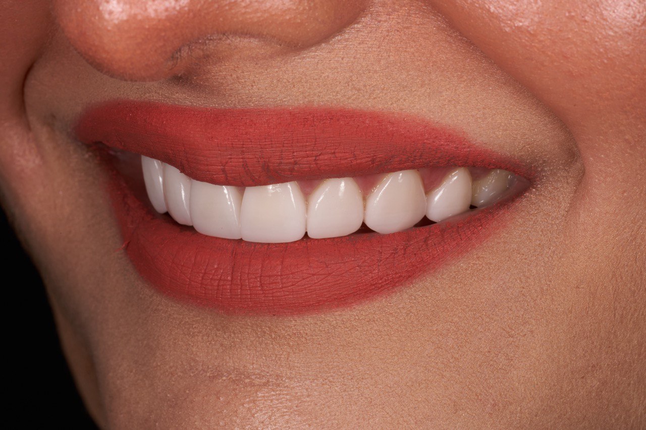 A Wedding Ready Smile Makeover - Deansgate Dental Studio | Dentist in ...